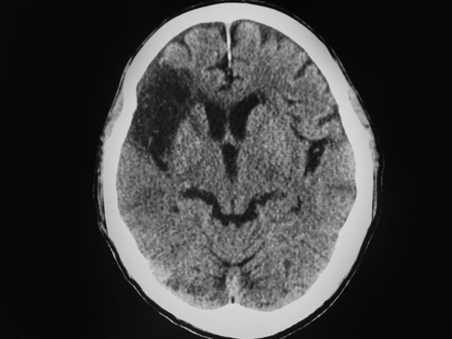 New AI stroke brain scan readings are twice as accurate as current ...